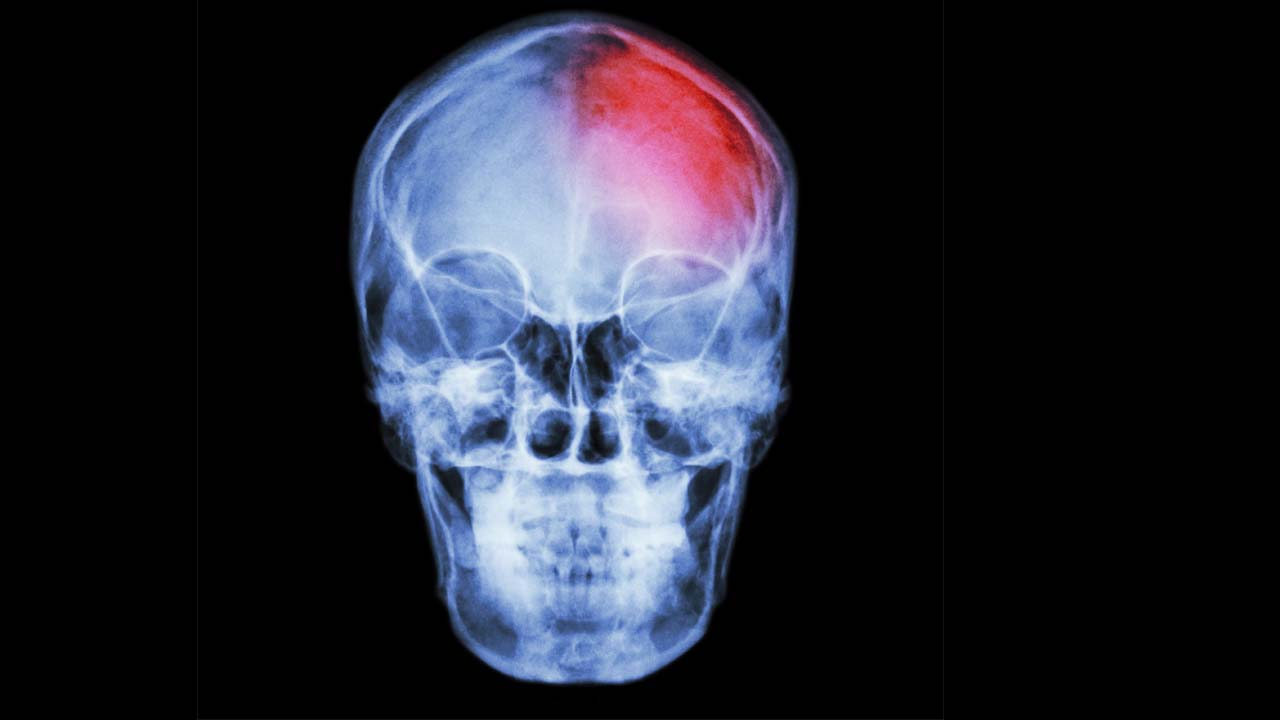 Spinal Cord & Brain Injury | PatientsLearn